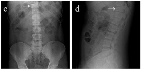 Clay Shoveler Fracture