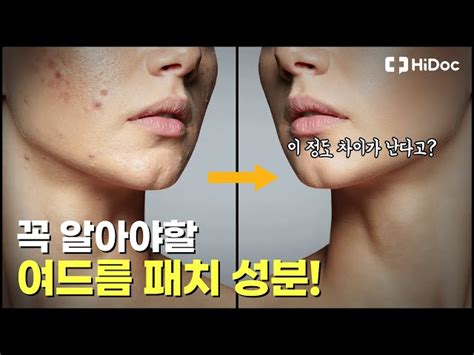 기껏 사서 붙였는데 흉터 생겼다” 상황에 알맞은 여드름 패치 선택법은