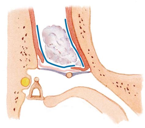 Management Of Tympanic Membrane Abnormalities Ento Key