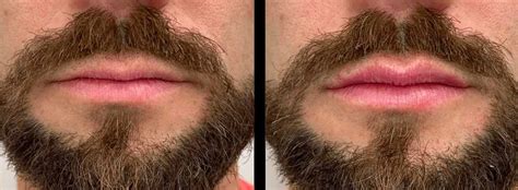 Lip Augmentation 21 Inspire Aesthetics