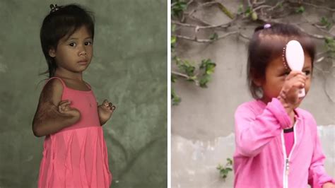 Cure International On Linkedin Curephilippines Globalsurgery