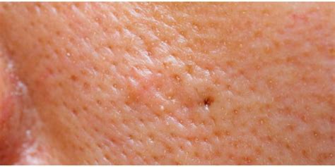 Cara Bikin Pori Pori Mengecil Agar Kulit Tampak Mulus Cuma Pakai 1 Kulit Buah Nggak Perlu Pakai