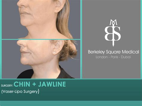 Vaser Lipo London Before After 13 Berkeley Square Medical Central