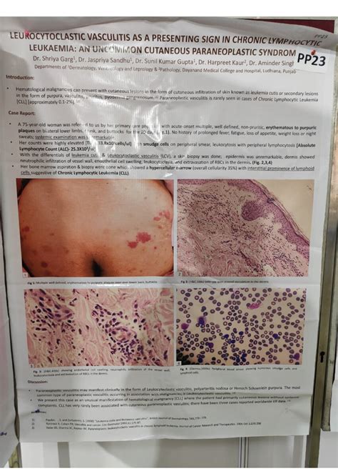 Pdf Leukocytclastic Vasculitis As A Presenting Sign In Chronic Lymphocytic Leukemia