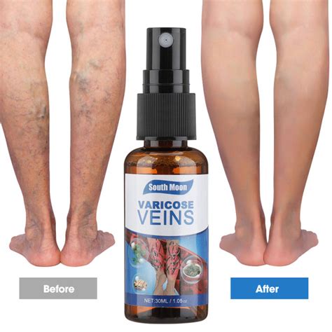Hailicare Varicose Vein Spray Active Loose Spray Smoothes Out Blood Vessel Bulges Beautify Legs