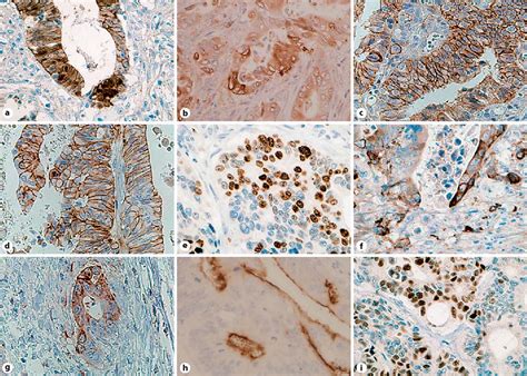 Figure 1 From A New Formula For Predicting Liver Metastasis In Patients With Colorectal Cancer