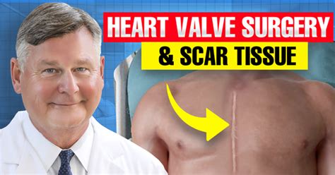 Surgeon Qanda Scar Tissue And Minimally Invasive Heart Surgery