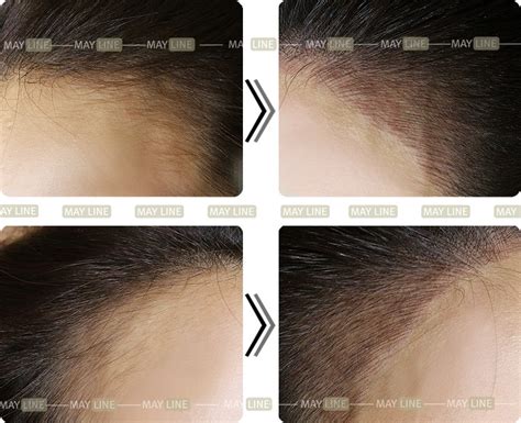 라인뷰티 섬세하게 채워지는 헤어라인 반영구화장 헤어라인이 고르지 않고 경계가 불분명해 고민이셨던