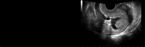 What Is Sonohysterogram In Infertility Dr Kaberi Banerjee