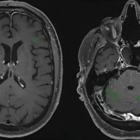 Axial Views On T1 Weighted Post Gadolinium Magnetic Resonance Imaging