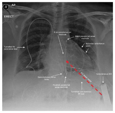Subcutaneous Icd Implant In A Low Left Lateral Position In A Patient