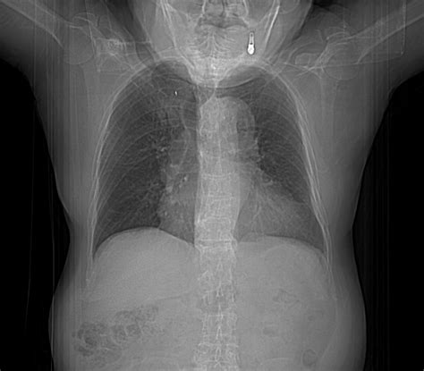 Faces Of The Aging Aorta The Common Vein