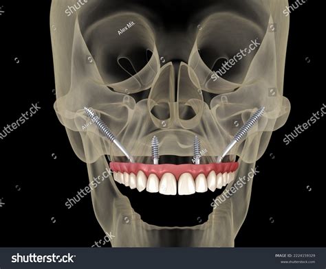 Zygomatic Process Of Maxilla X Ray