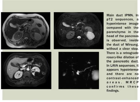 Figure 1 From Pancreatic Cystic Lesions Our Approach To And Old