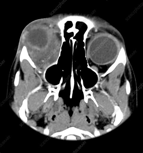 Orbital Pseudotumor On Ct Stock Image C043 0427 Science Photo Library