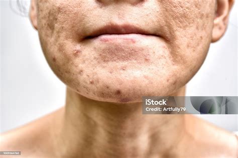 여드름 질환 피부 문제 가까이 여자 얼굴에서 턱 생리 브레이크 아웃 흉터와 기름진 기름기 얼굴 뷰티 개념에 화이트 헤드 여드름