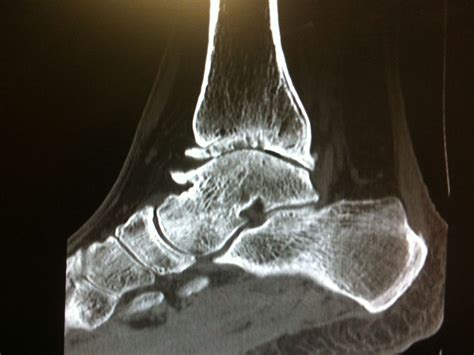 Center For Foot And Ankle Surgery Foot And Ankle Arthritis