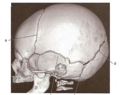 Sutures Of The Skull On Ct Image Quiz