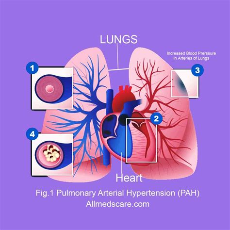 Pulmonary Arterial Hypertension Information Risks And Treatment