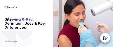 Bitewing X Ray Definition Uses And Key Differences Craniocatch