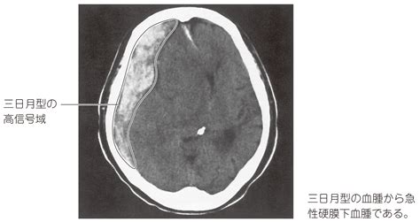 101c33 急性硬膜下血腫 国試 M3e Medical