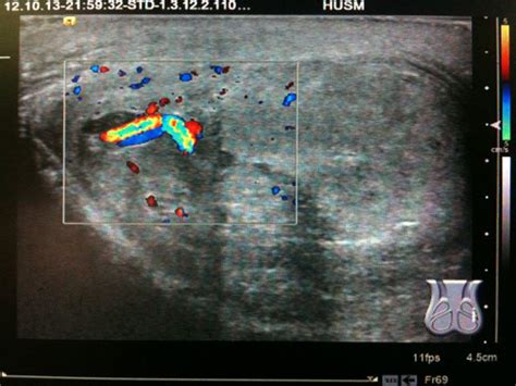 Color Doppler Ultrasound Demonstrating Normal Doppler Signal On