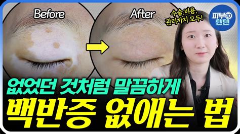 백반증 완치를 위한 수술 총정리 백반증수술 백반증수술과정 백반증치료 백반증수술금액 백반증없애는법 백반증 백반증연고 백반증약 피부과전문의 백반증피부과 Youtube