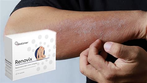 Renovix ของแท้ลด 50 รักษาโรคผิวหนังจากเชื้อราให้หายขาดภายใน 20 วัน