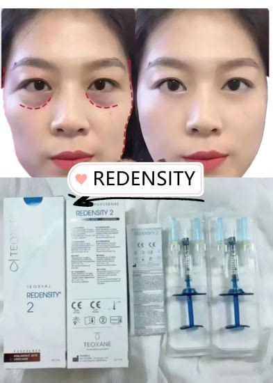 Teosyal Redensity Ii Treatment Under Eye Circle Fighter Tear Trough