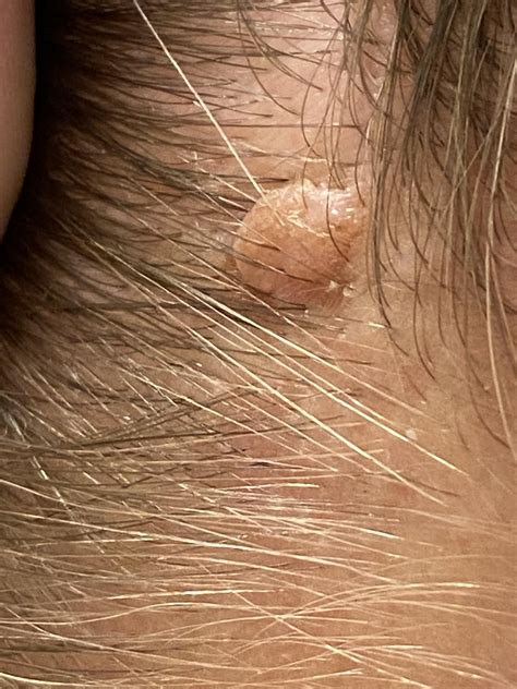 Is This Scalp Nevus R Dermatologyquestions