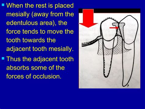 26 Designing Of Rpd Ppt Dental Health Diseases And Conditions