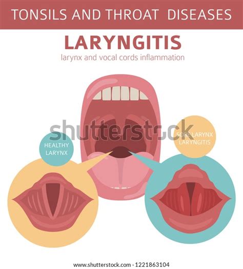 Tonsils Throat Diseases Laryngitis Symptoms Treatment Stock Vector