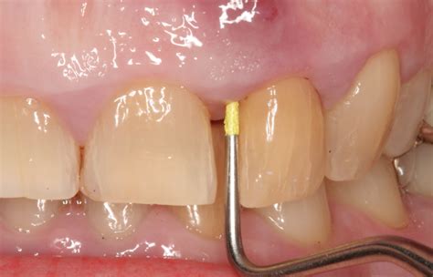 Periodontal Splinting For Mobile Teeth French Dental Services Drmiski