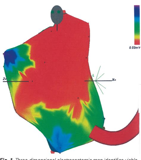 Figure 1 From Transvenous Right Atrial And Left Ventricular Pacing After The Fontan Operation