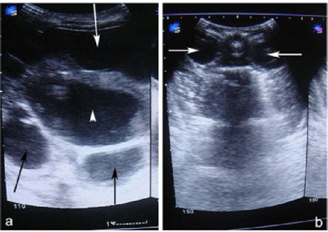 Figure 1 From Persistent Cloaca Lessons Learnt From A Case Semantic Scholar
