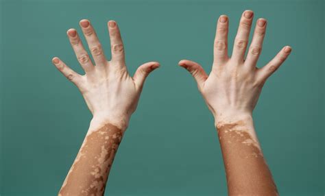 Assessing Vitiligo Treatment Defining Meaningful Repigmentation