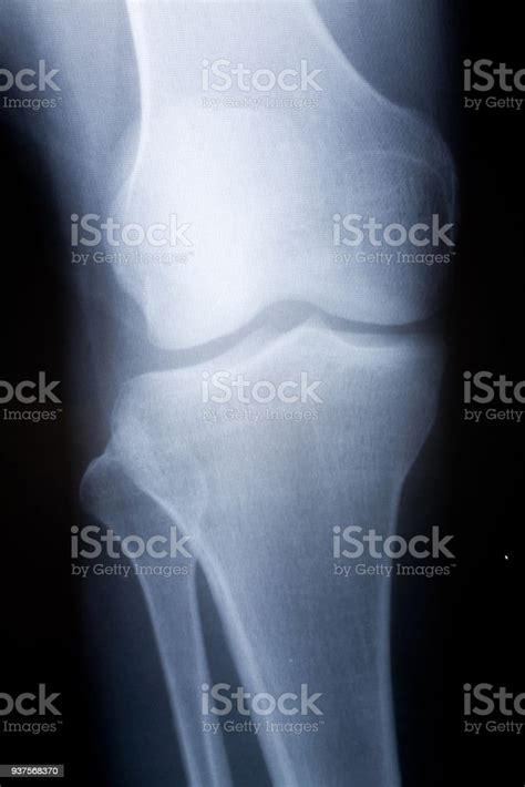 무릎 X선 이미지 X 레이에 대한 스톡 사진 및 기타 이미지 X 레이 건강 진단 건강관리와 의술 Istock