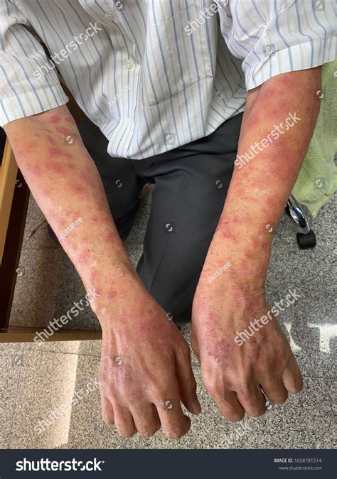 What Causes A Rash On Both Arms At Benjamin Hutchison Blog