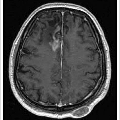 T 1 Weighted Axial Brain Magnetic Resonance Mr Imaging Demonstrating