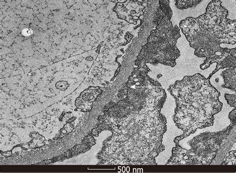 Electron Microscopy Showed Subepithelial Electron Dense Deposits ×