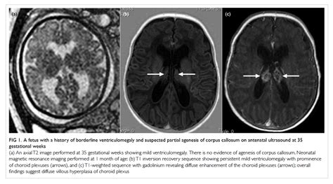 Magnetic Resonance Imaging Of The Fetal Brain Hkmj