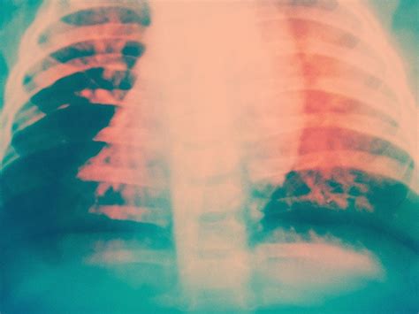 Pulmonary Hypertension Diagnosis Tests Criteria What To Expect