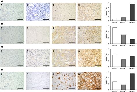 Hla‐i Molecules Are Expressed In Human Glioblastoma In Vivo Download Scientific Diagram