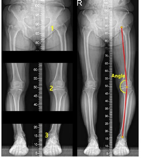 Figure 1 From Measurement Of Lower Extremity Alignment Using A