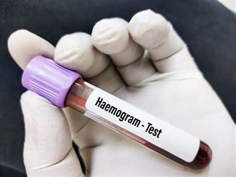Why Is A Hemogram Test Prescribed Topics Reader