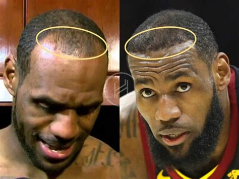 Lebron James Hair Transplant Hair Loss And Technical Analysis