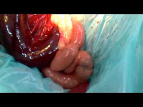 CASAL DO RIO VIDEOS Viabilidad Intestinal En La Cirugia Del Colico