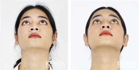 Rhinoplasty Nose Job Revision Rhinoplasty