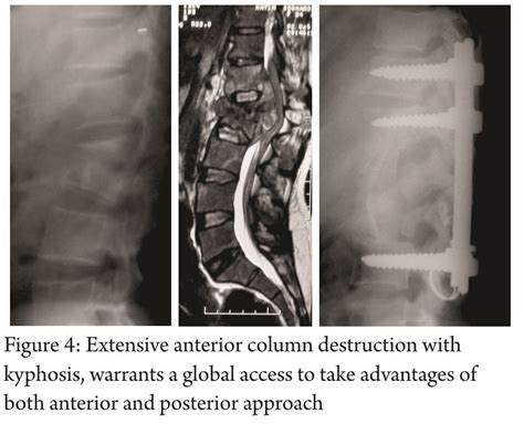 Spinal Tuberculosis An Update Journal Of Clinical Orthopaedics
