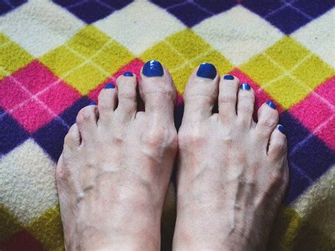 Metatarsalgia Pain In The Ball Of Your Foot Causes And Treatment